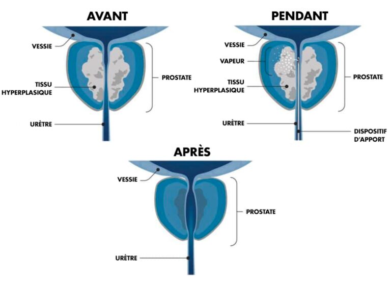 Rezum - Techniques et tarifs | Urologie Paris Opéra